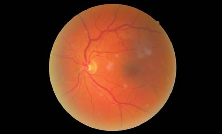 Optometry case study – Transient visual loss | Spectrum