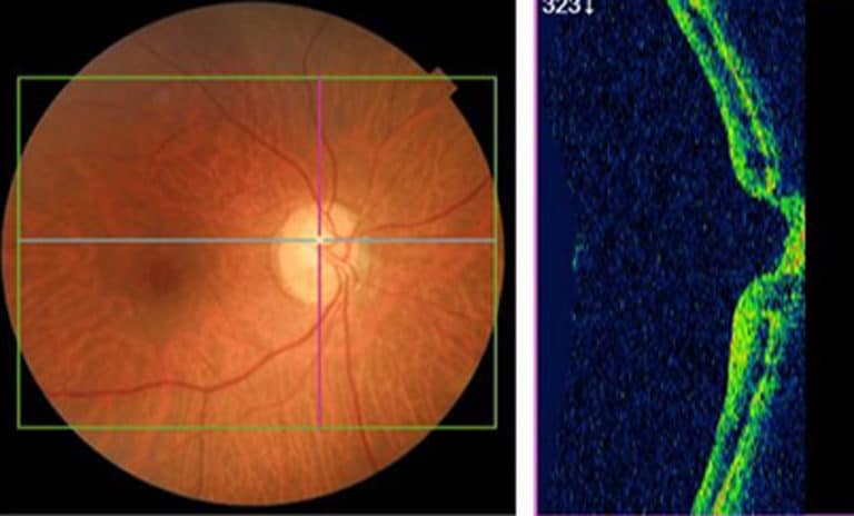 Optometry case study – OCT clinical indicators for functional testing ...