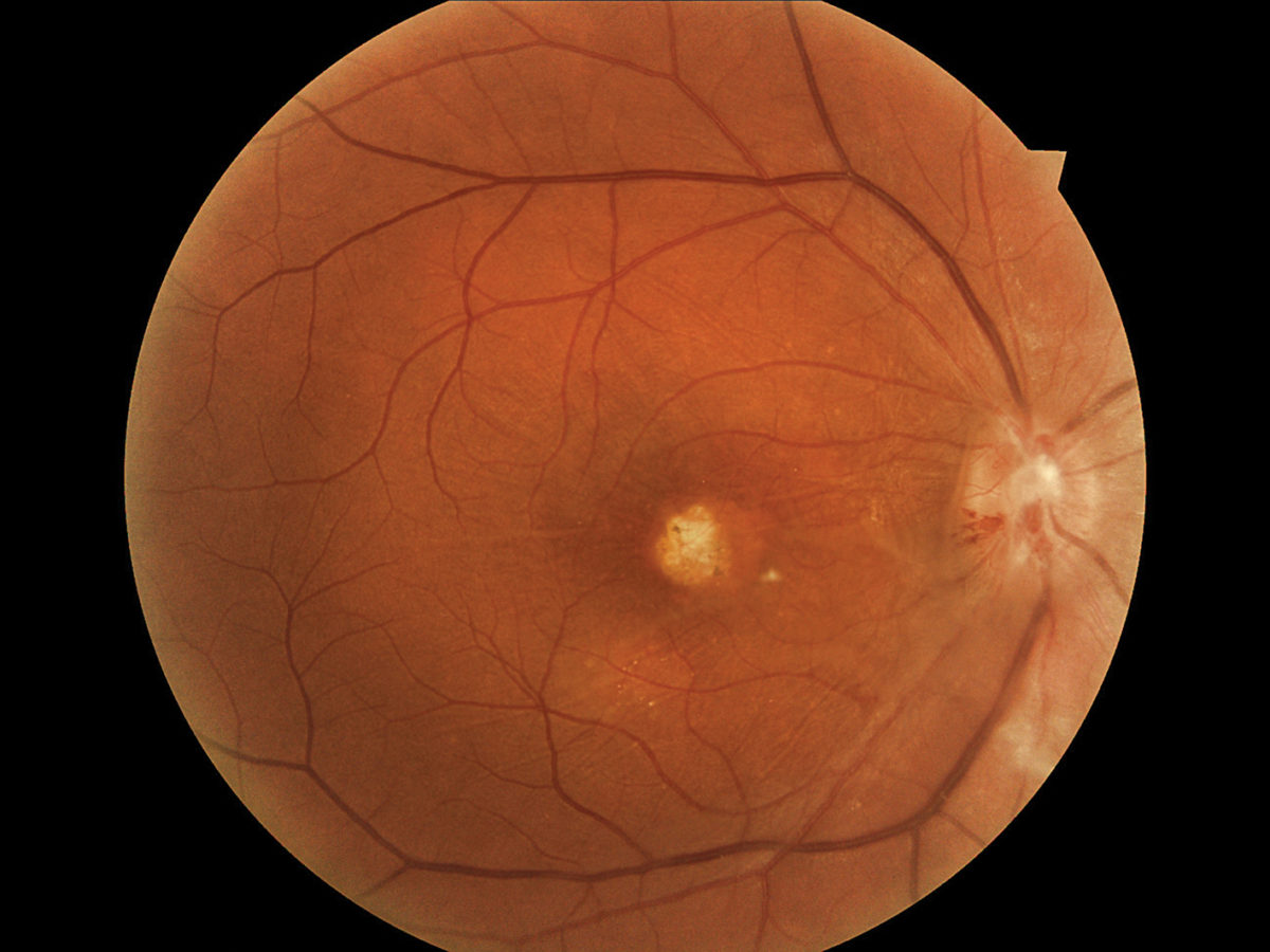 Clinical photography - Cat scratch disease | Spectrum