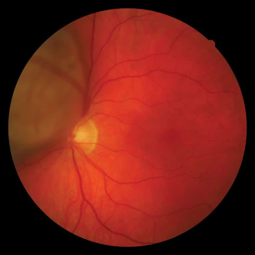 Clinical photography - Choroidal melanoma | Spectrum