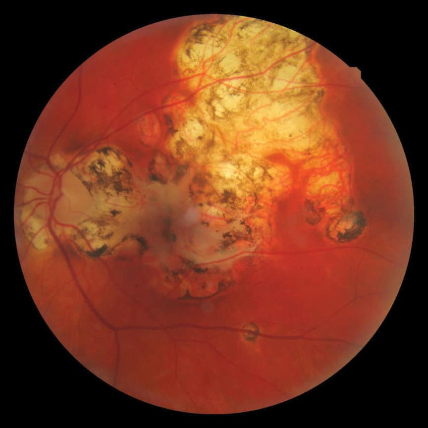 Toxoplasmose Ocular Toxoplasmose Ocular